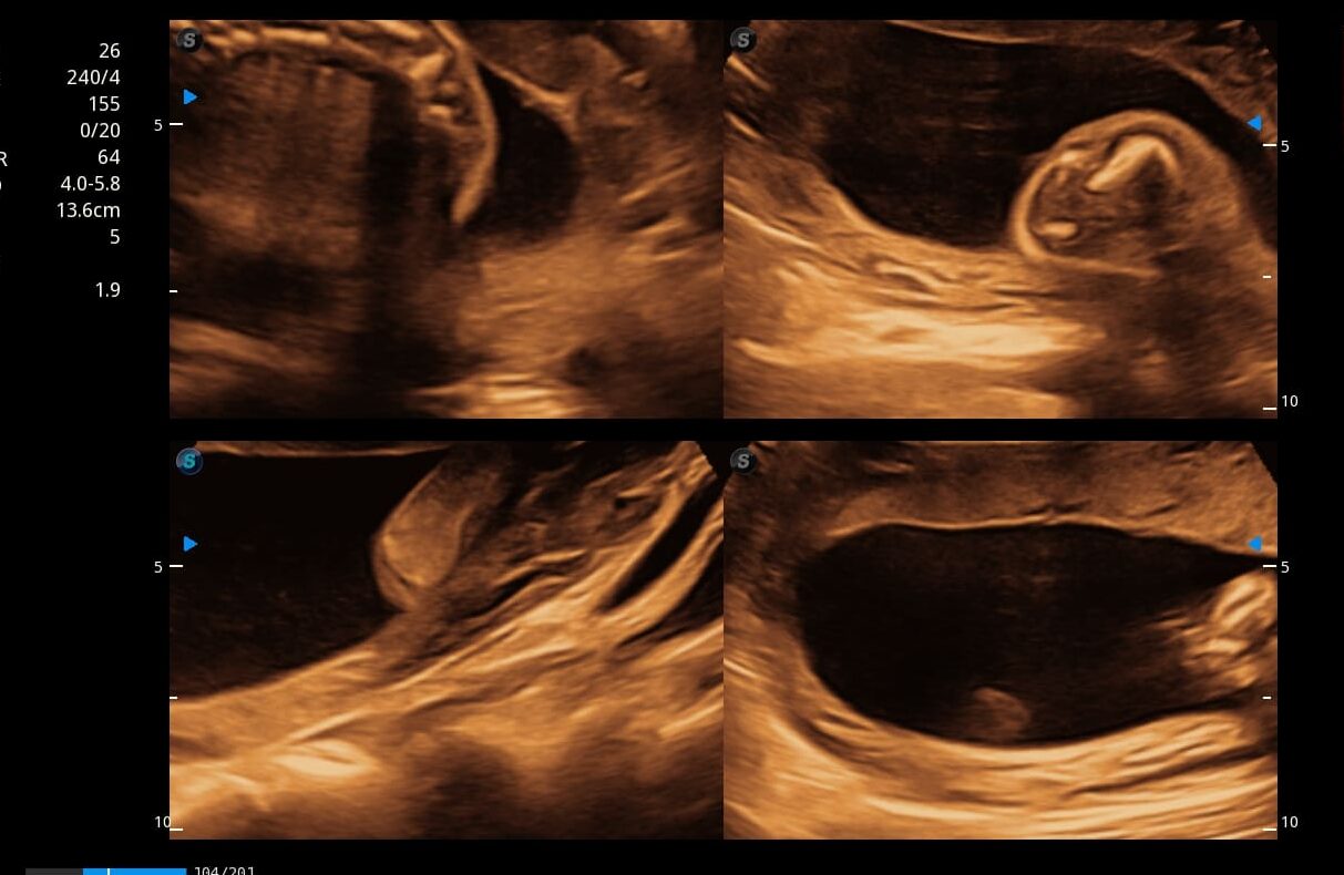 Ecografía Doppler en el embarazo: utilidad e indicaciones